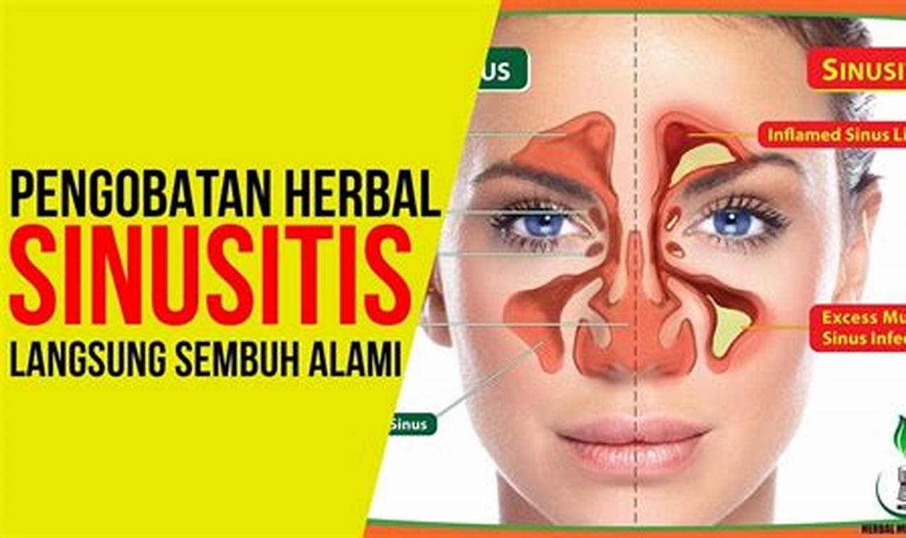 Cara Mengatasi Sinusitis: Panduan Lengkap | investigasi.id